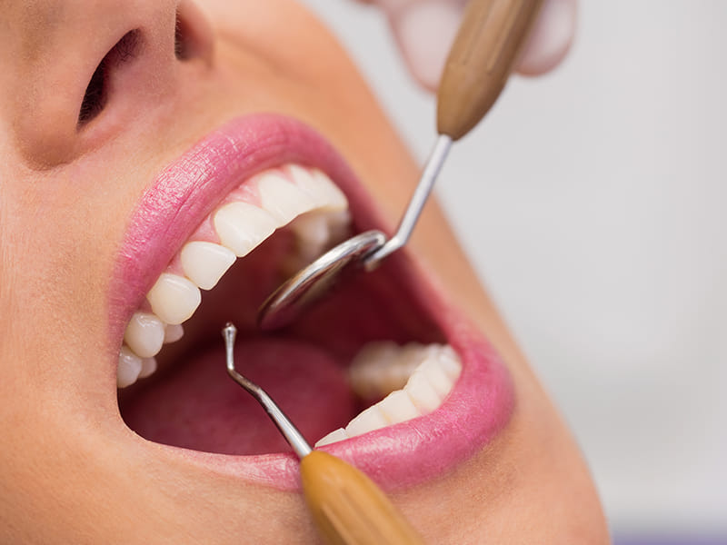 Diş Plağı ve Karbonhidratlı Gıdalar Neden Çürük Oluşturur? - Diş Hekimi